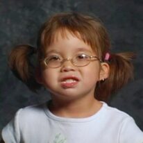 Stickler Syndrome | Causes, Signs, & Symptoms | Marfan Foundation