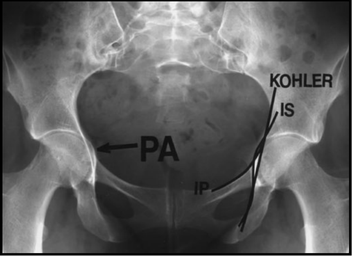 Calculation of Systemic Score - Marfan Foundation