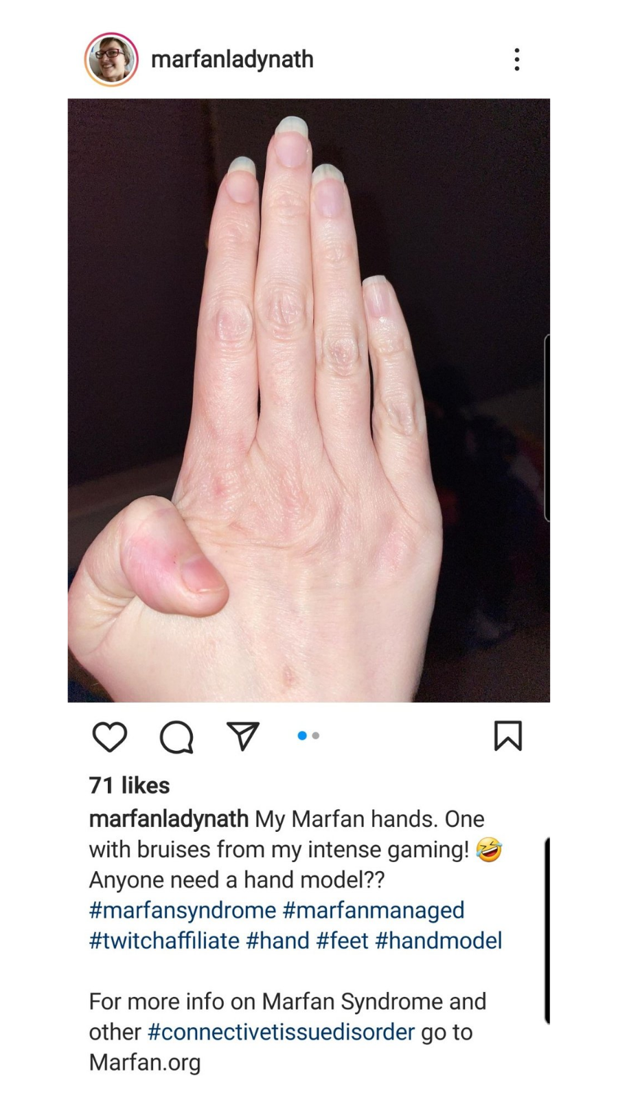 Awareness is Never Losing Someone Unexpectedly to Marfan Syndrome ...